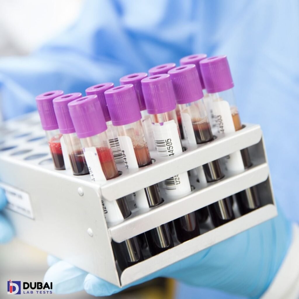 Lipid Profile I-(Cholesterol, Triglycerides, HDL, LDL, HDL/Cholesterol ...